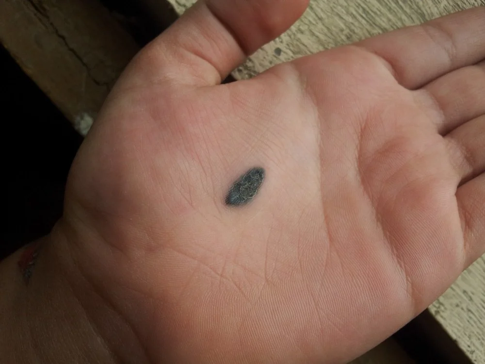 Early Acral Lentiginous Melanoma Palm