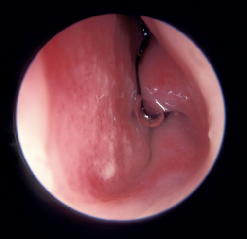 Rhinorrhoea — ent4gp.com