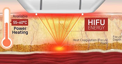 HIFU - GC Skin Boutique — GC Skin Boutique