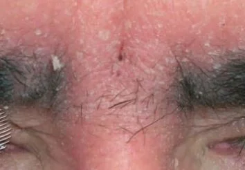 Live Oak Dermatology - Brent Goedjen, MD - Seborrheic Dermatitis (Dandruff)