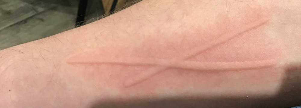 Live Oak Dermatology - Brent Goedjen, MD - Dermatographic Urticaria