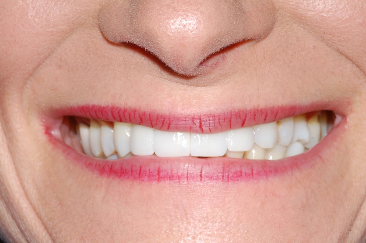 Implant Fixed Bridge Gallery — Texas Dental Solutions