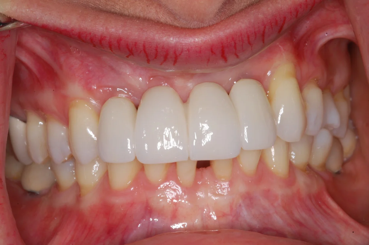 Implant Fixed Bridge Gallery — Texas Dental Solutions