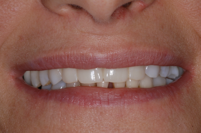 Implant Fixed Bridge Gallery — Texas Dental Solutions