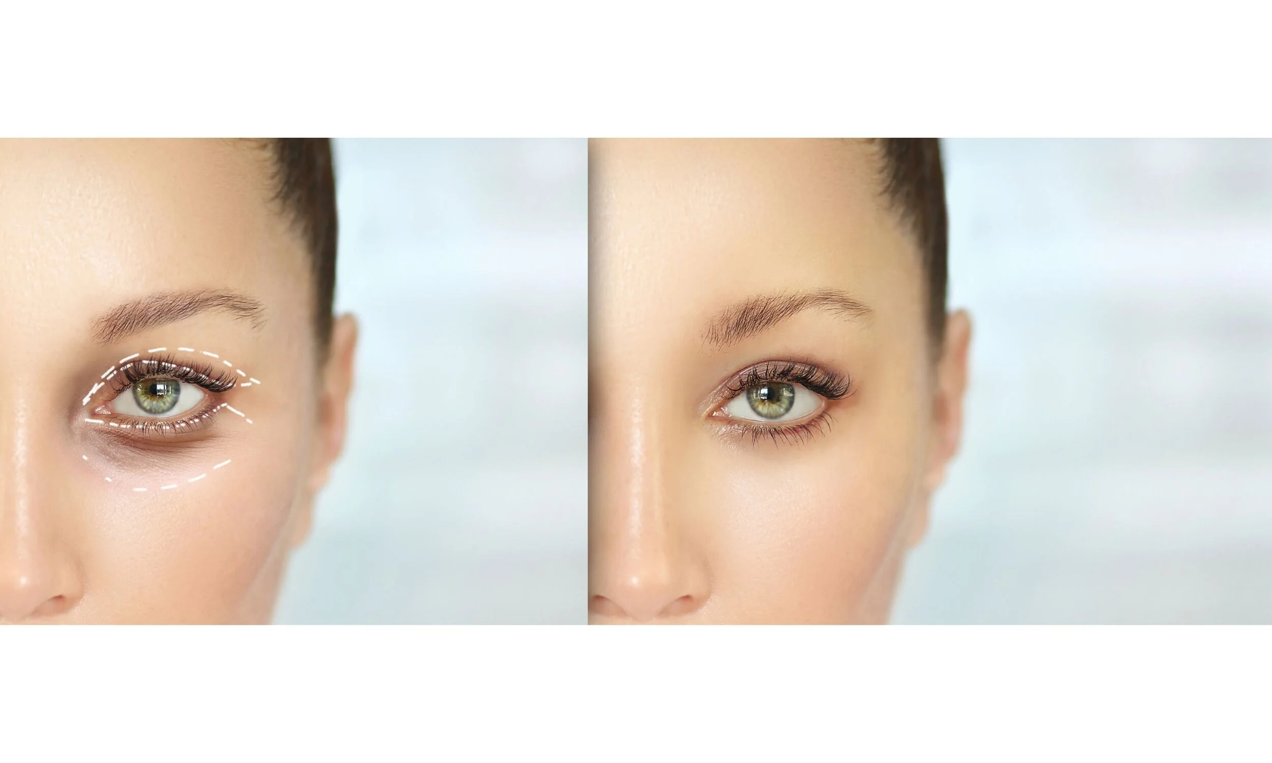 Blepharoplasty — The Glow Plastic Surgery