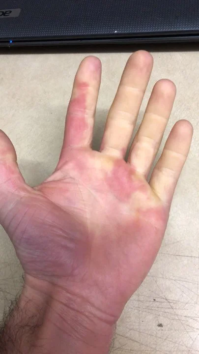 Raynaud's awareness month — Nourish