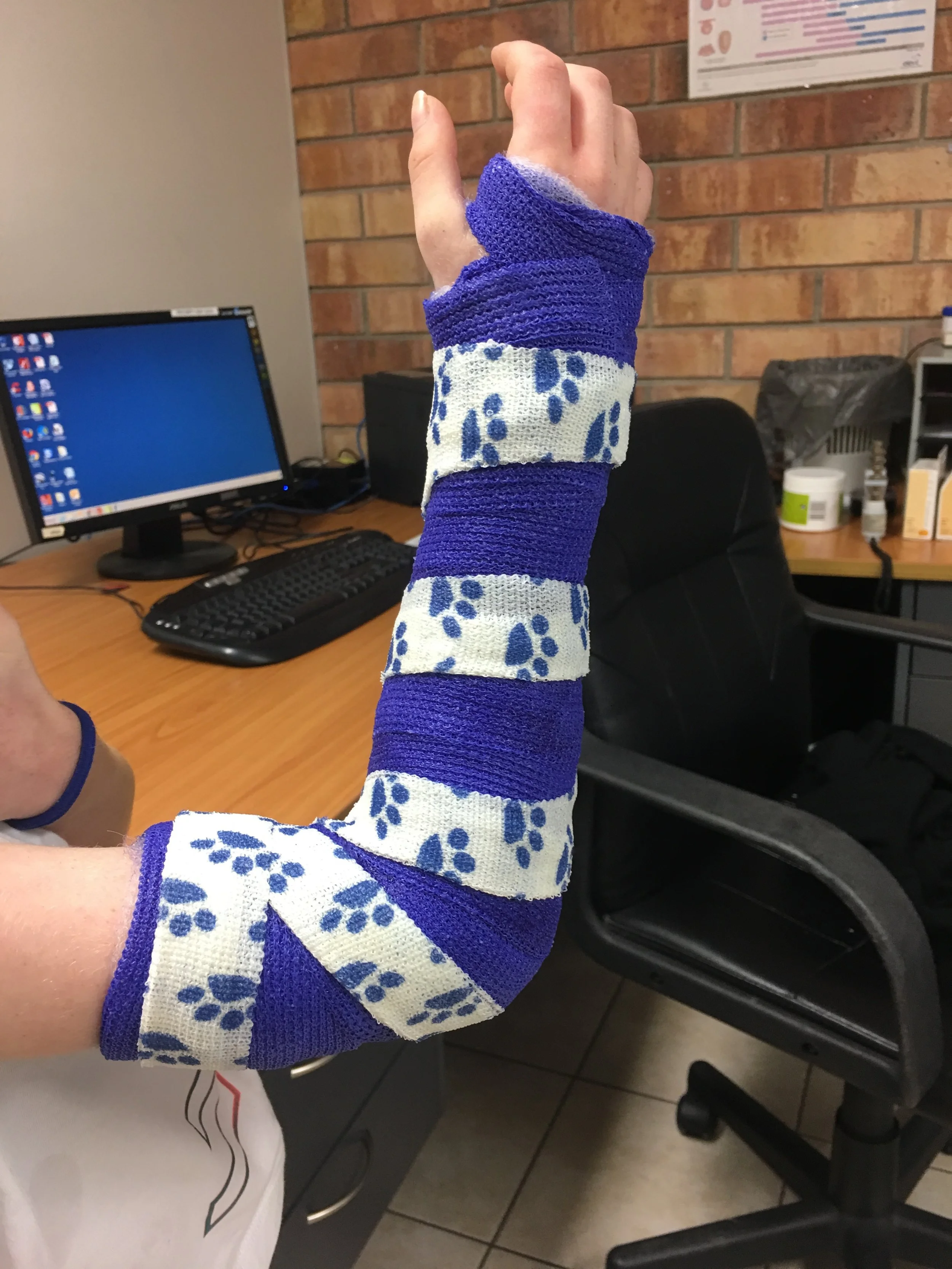 Waterproof Casts — Advanced Health & Hand Therapy