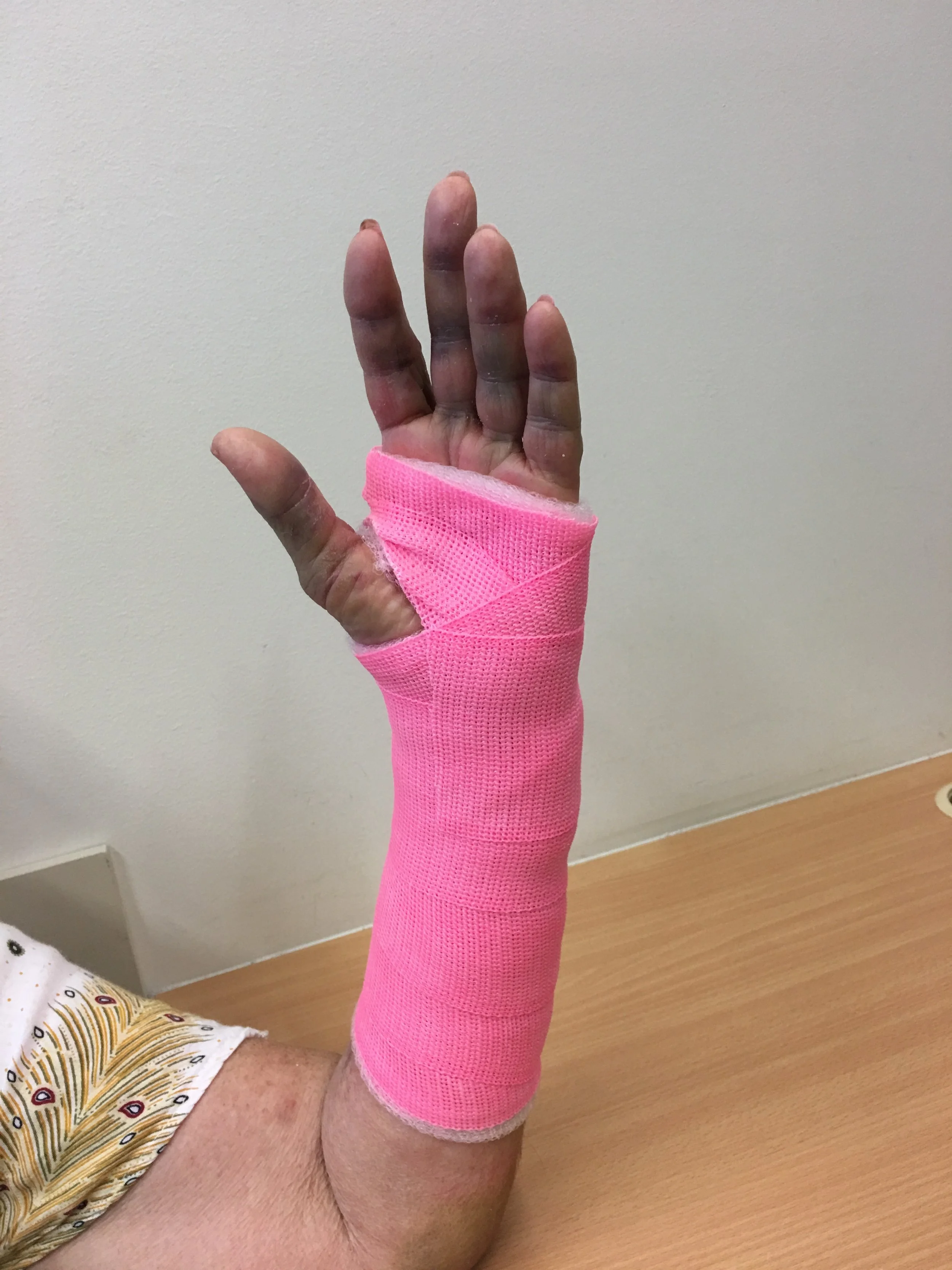 Waterproof Casts — Advanced Health & Hand Therapy