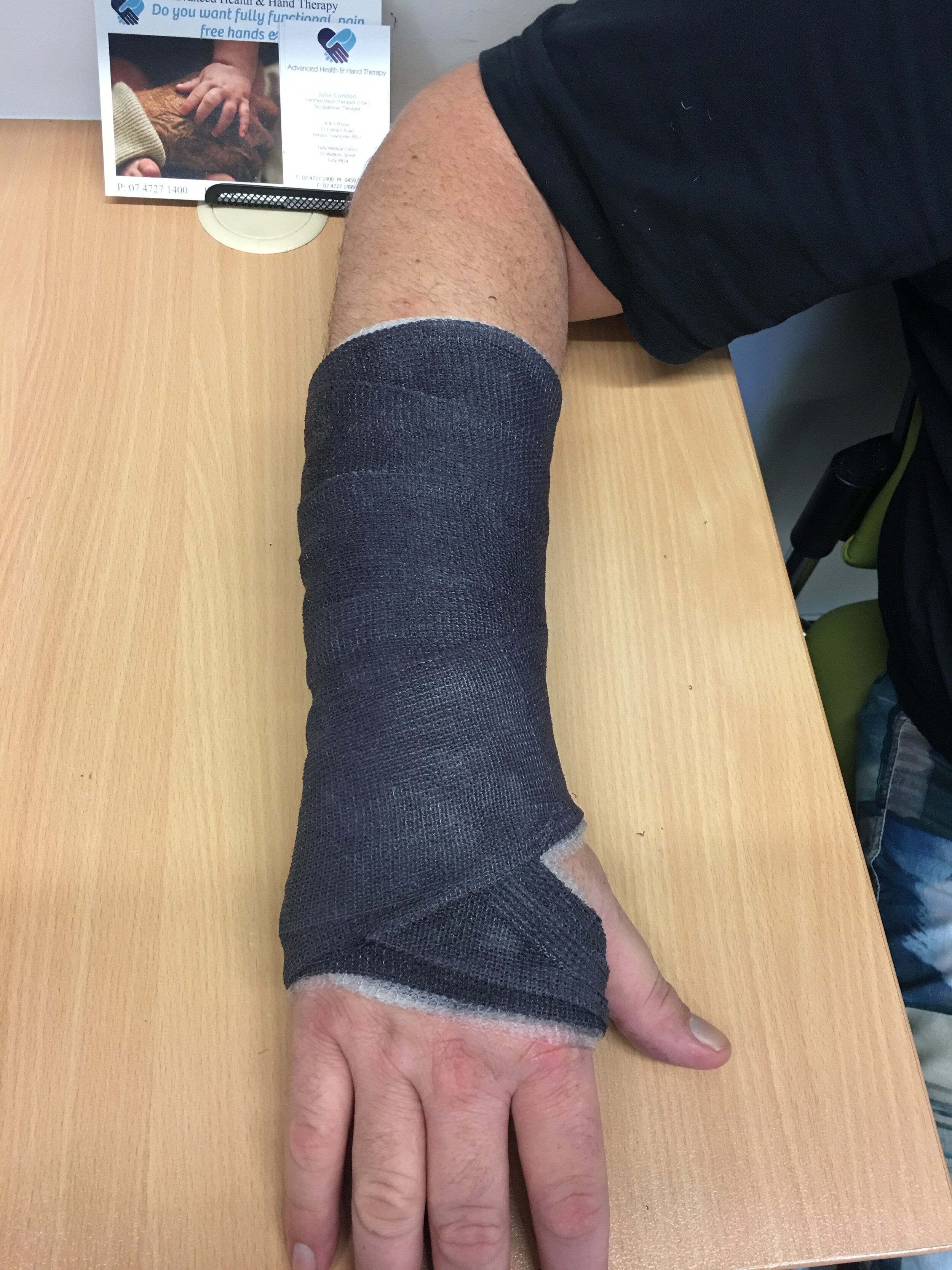 Waterproof Casting — Advanced Health & Hand Therapy