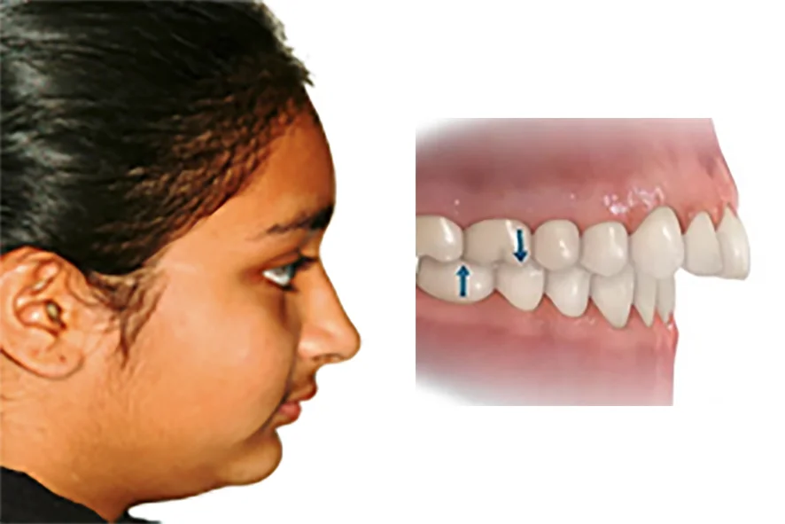 Braces for Teenagers — Professor Ama Johal