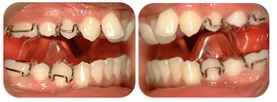 Braces for Teenagers — Professor Ama Johal