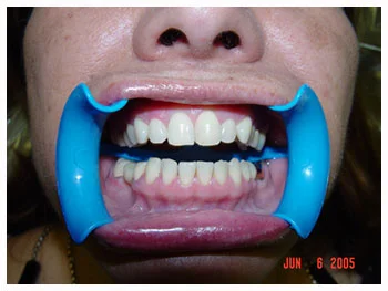 Smile Gallery — Gad Dental – Your Local Dentist in La Mirada