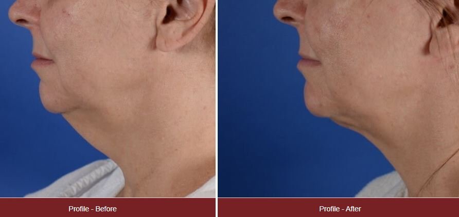 4 Ways to Reduce a Double Chin — Aesthetics by Design