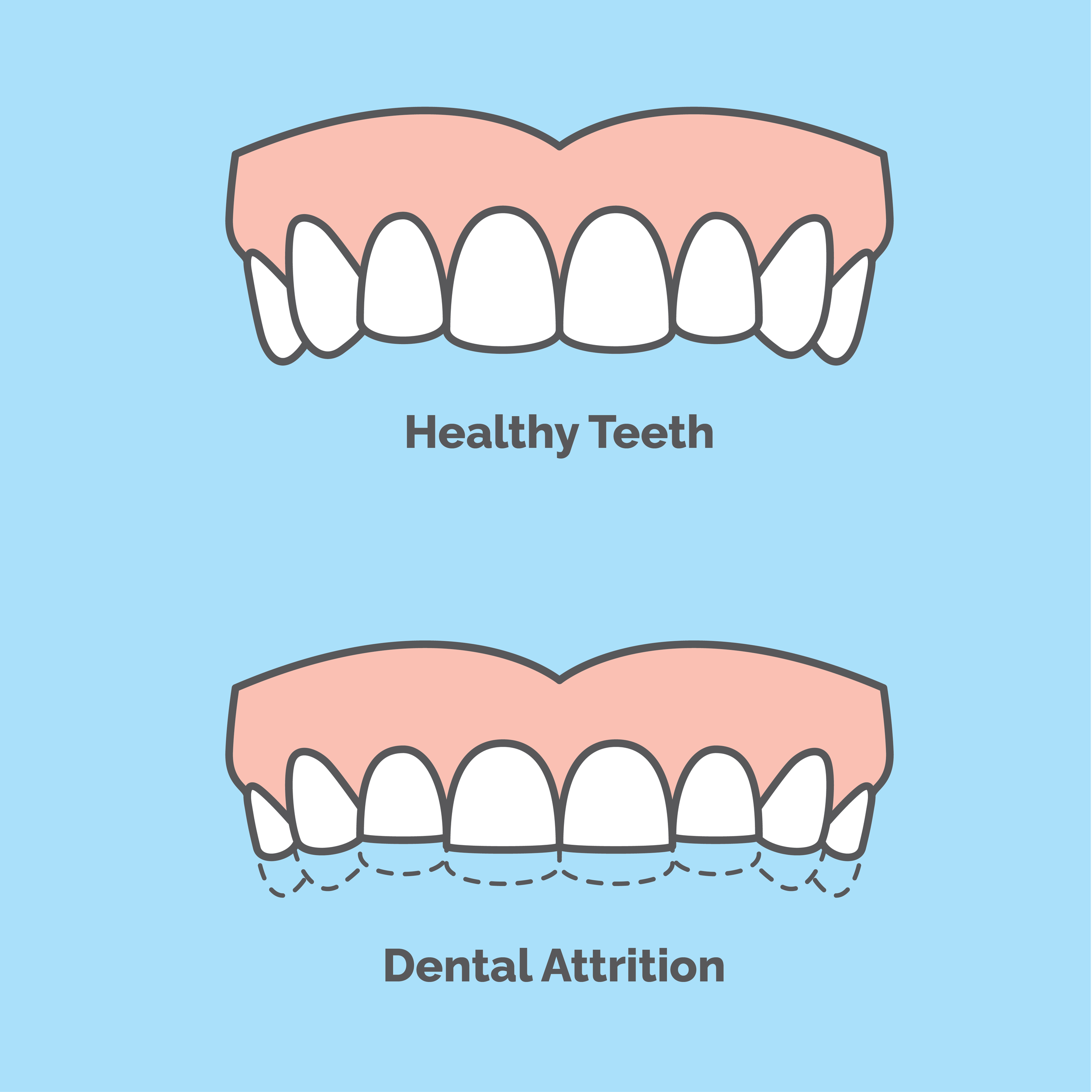 What Is Clenching Teeth A Symptom Of