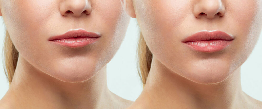 Lip Injector pen - munimoro.gob.pe