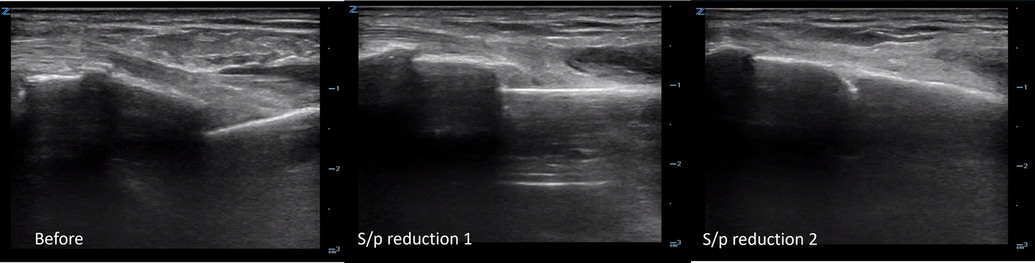 VOTW: Distal Radius Fracture — Maimonides Emergency Medicine Residency