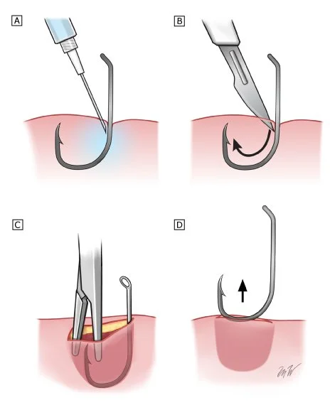 POTD: Fishhook Injury — Maimonides Emergency Medicine Residency