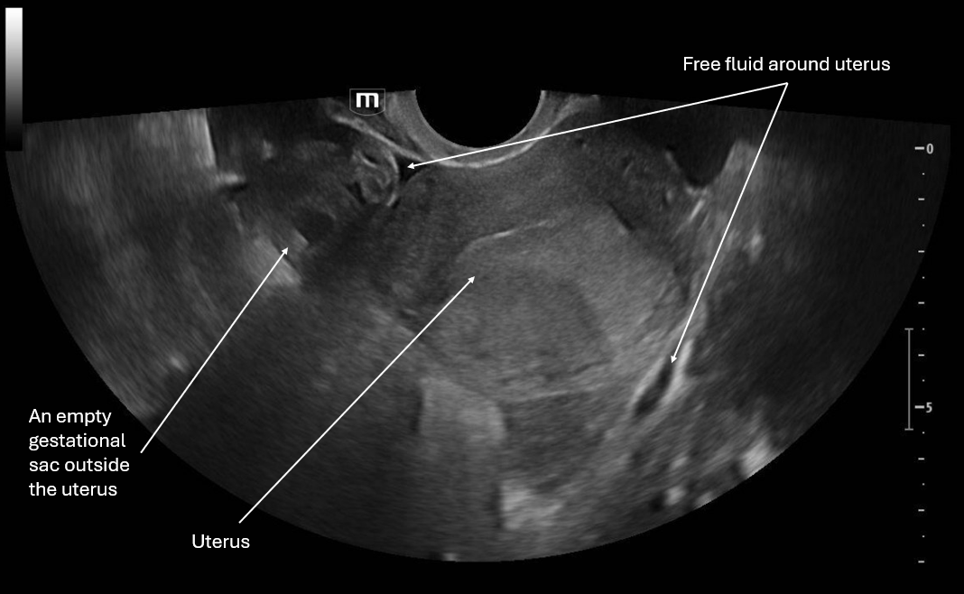 VOTW: Ring of Fire — Maimonides Emergency Medicine Residency
