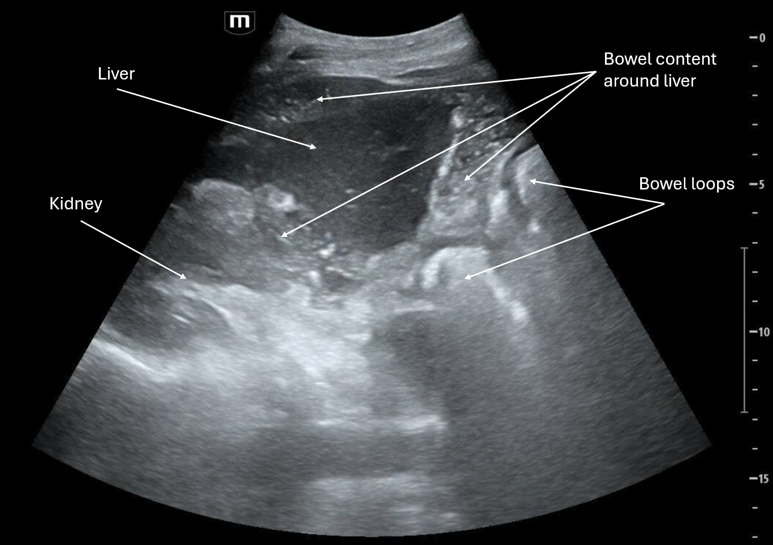 VOTW: Blood or Bowel? — Maimonides Emergency Medicine Residency