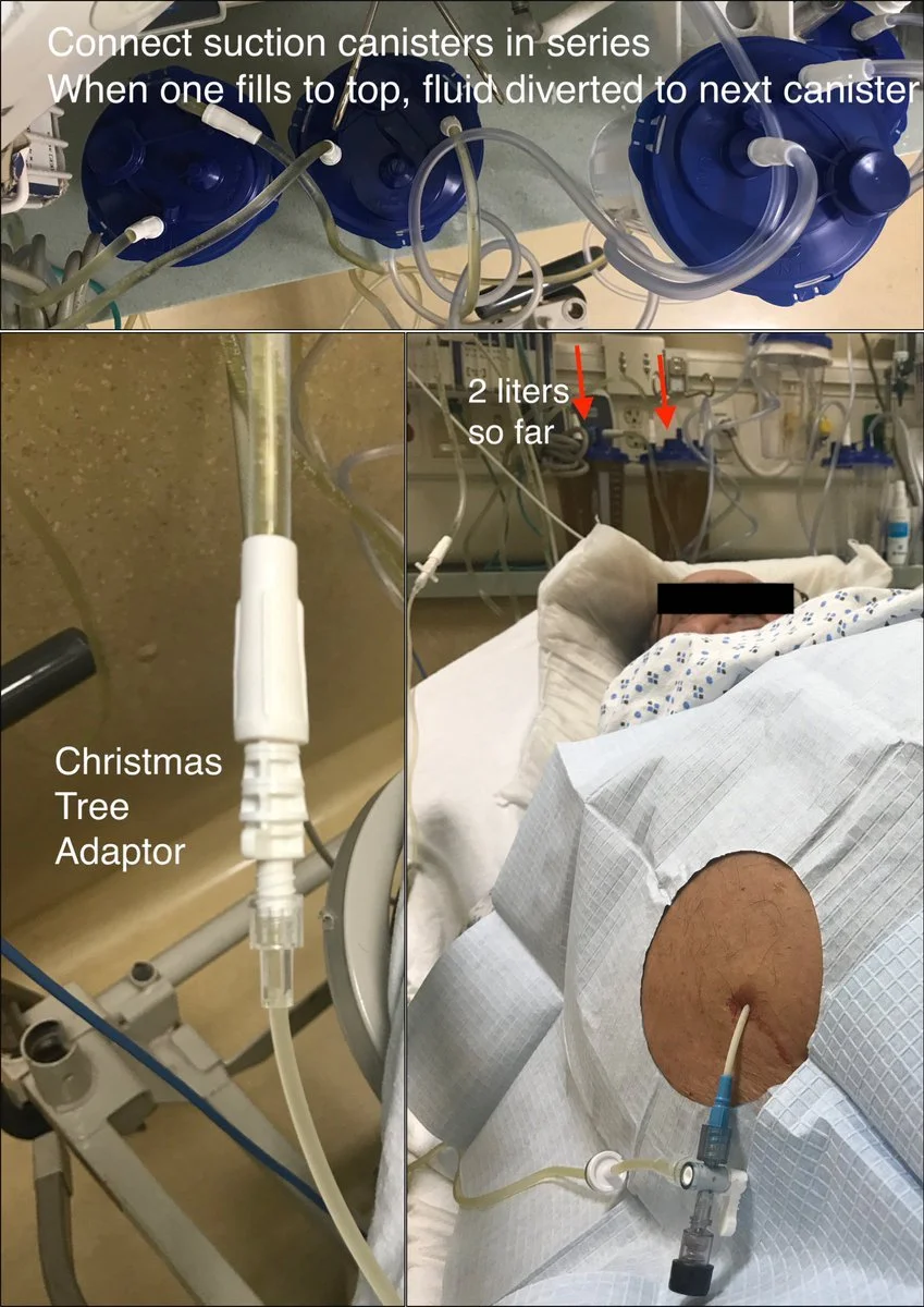 Suction cannisters in series — Maimonides Emergency Medicine Residency