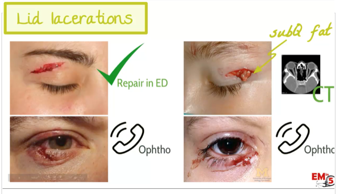 POTD: Trauma Tuesday - Eye trauma review — Maimonides Emergency ...