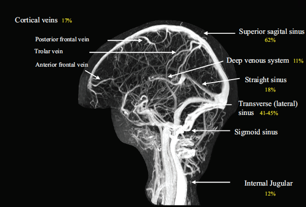 POTD: Cerebral Venous Sinus Thrombosis (CVST) — Maimonides Emergency ...