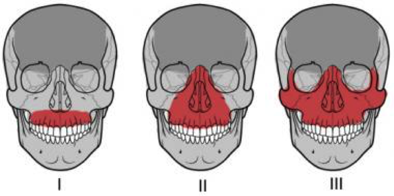 POTD: Trauma Tuesdays. Le Forte Fractures — Maimonides Emergency ...