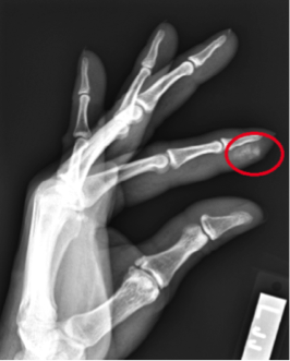 POTD: High-Pressure Injection Injury — Maimonides Emergency Medicine ...