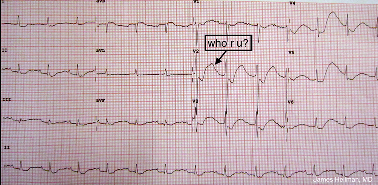 ECG: What about U waves? — Maimonides Emergency Medicine Residency