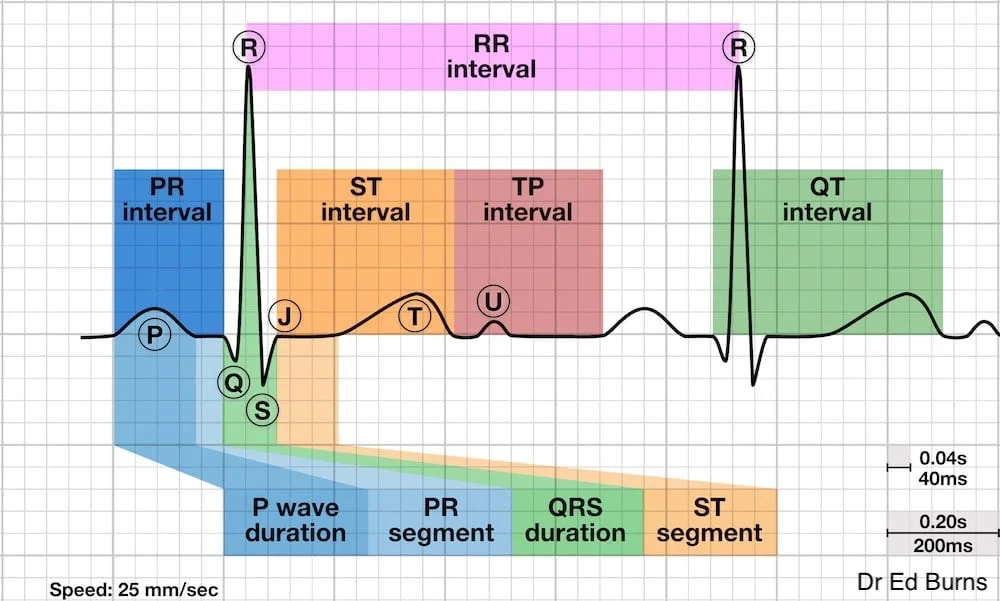 ECG: What about U waves? — Maimonides Emergency Medicine Residency