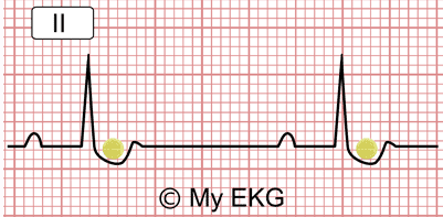 ECG: What about U waves? — Maimonides Emergency Medicine Residency