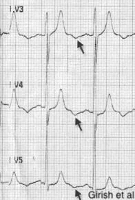 ECG: What about U waves? — Maimonides Emergency Medicine Residency