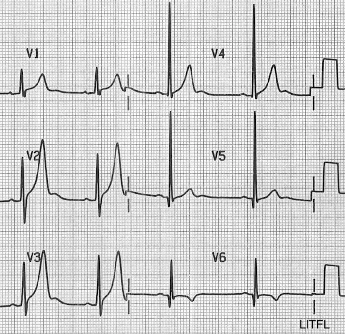 ECG: What about U waves? — Maimonides Emergency Medicine Residency