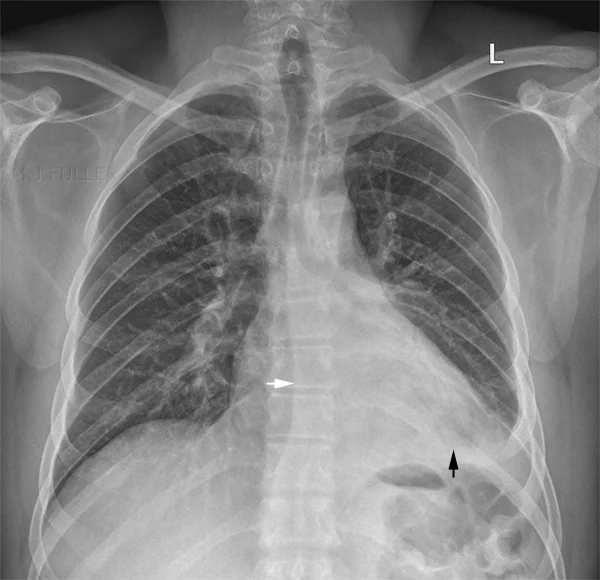 systematic approach to reading CXR and hidden pneumonias — Maimonides ...
