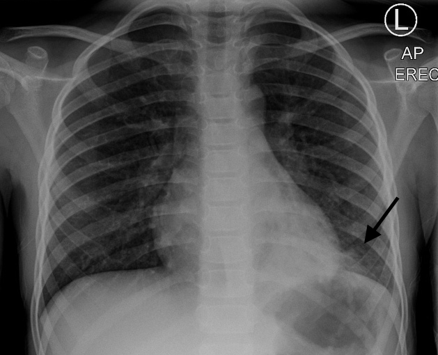 systematic approach to reading CXR and hidden pneumonias — Maimonides ...