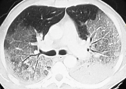 ARDS — Maimonides Emergency Medicine Residency