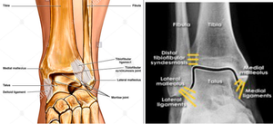 Ankle fractures — Maimonides Emergency Medicine Residency