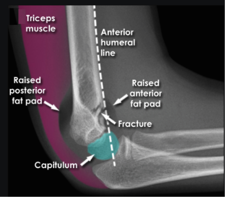 Supracondylar Fractures — Maimonides Emergency Medicine Residency