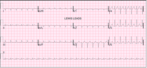 Irregular Rhythms — Maimonides Emergency Medicine Residency