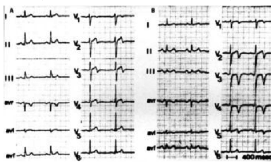 STEMI Equivalents — Maimonides Emergency Medicine Residency