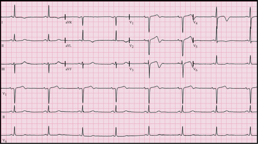 STEMI Equivalents — Maimonides Emergency Medicine Residency