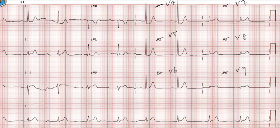 STEMI Equivalents — Maimonides Emergency Medicine Residency
