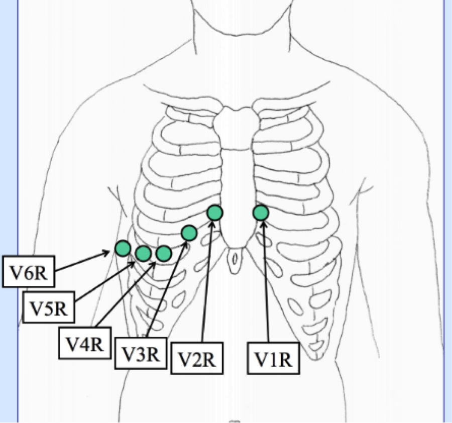 STEMI Equivalents — Maimonides Emergency Medicine Residency