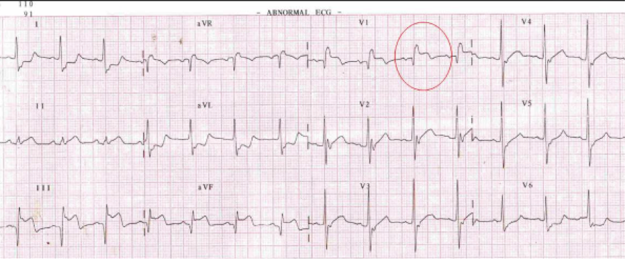 STEMI Equivalents — Maimonides Emergency Medicine Residency
