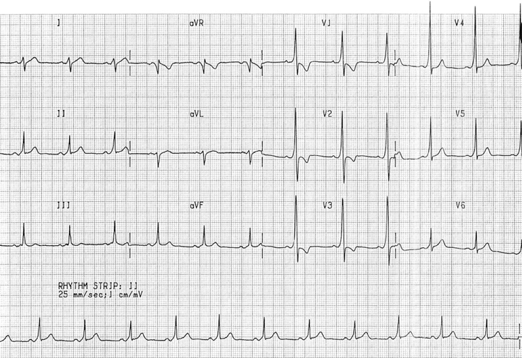 EKG in Syncope — Maimonides Emergency Medicine Residency