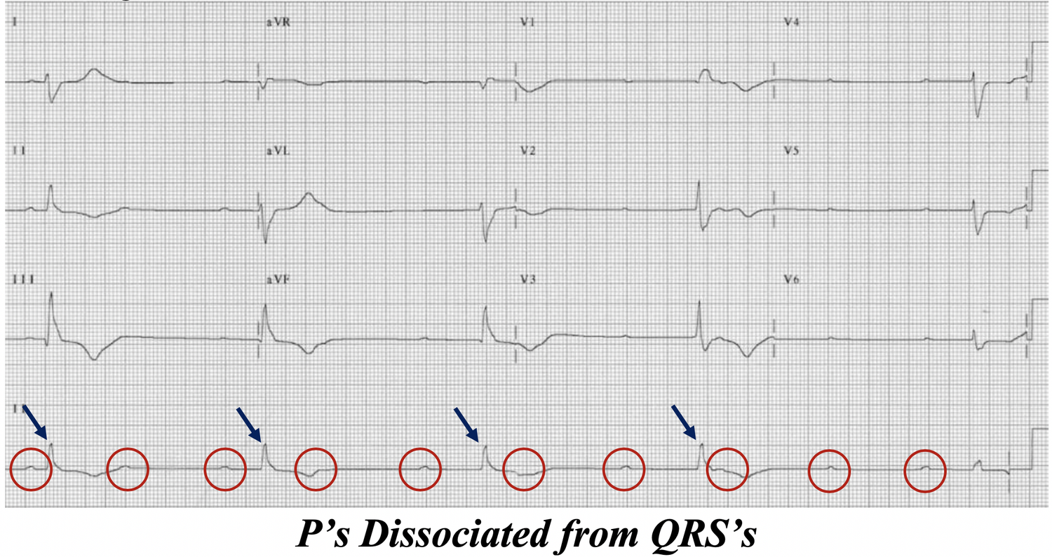 EKG in Syncope — Maimonides Emergency Medicine Residency
