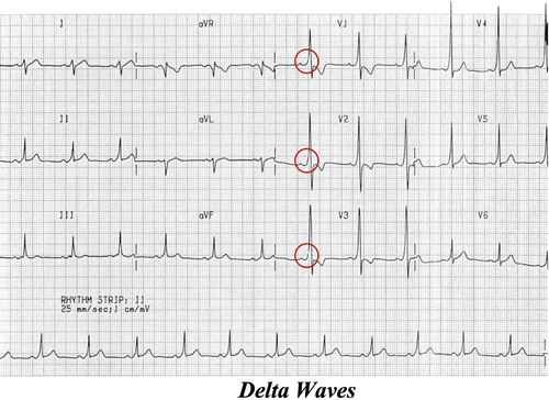 EKG in Syncope — Maimonides Emergency Medicine Residency