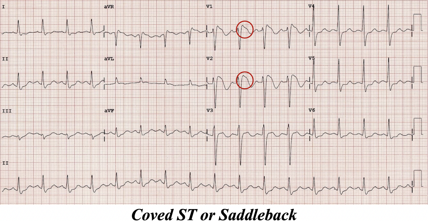 EKG in Syncope — Maimonides Emergency Medicine Residency