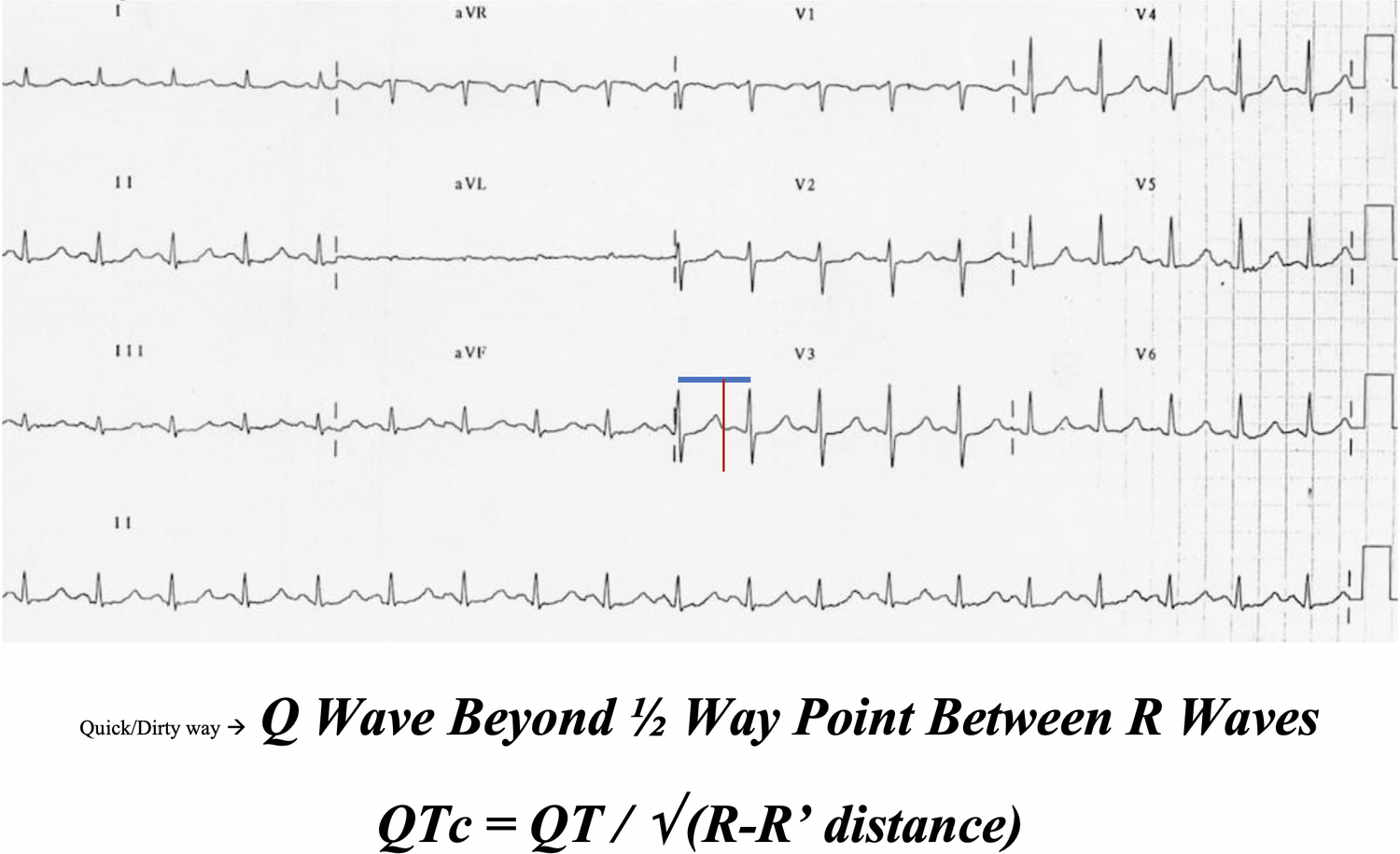 EKG in Syncope — Maimonides Emergency Medicine Residency