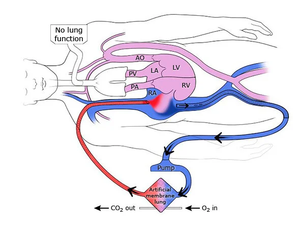 ECMO — Maimonides Emergency Medicine Residency